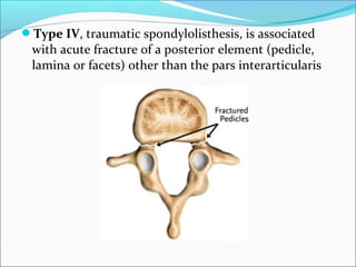 Traumatic Spondylolisthesis | PPT