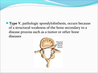 Traumatic Spondylolisthesis | PPT