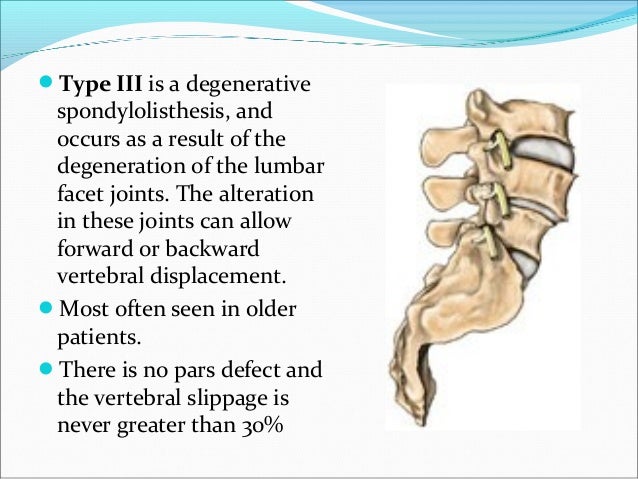 Spondylolisthesis Types