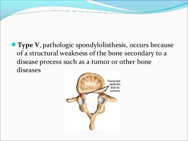 Spondylolisthesis Types