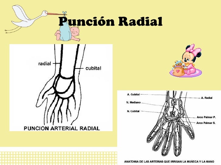 Punción arterial pcte pediátrico