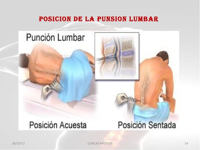 Puncion lumbar | PPT