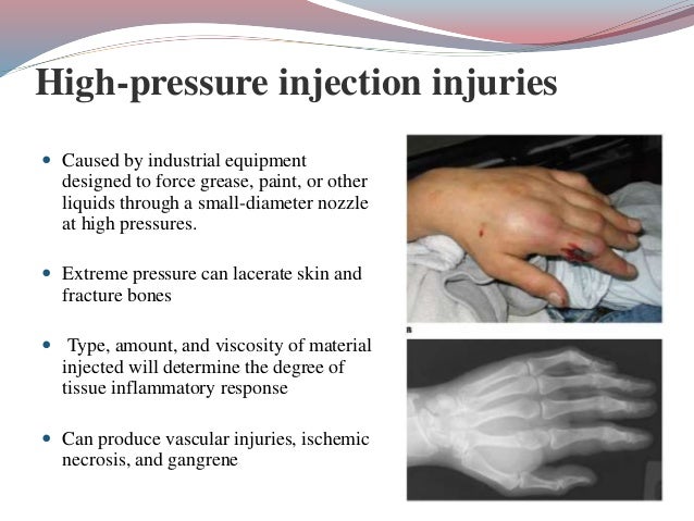 Puncture wounds and bites