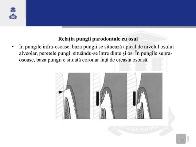 Punga parodontală.pptx