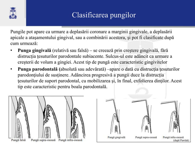 Punga parodontală.pptx