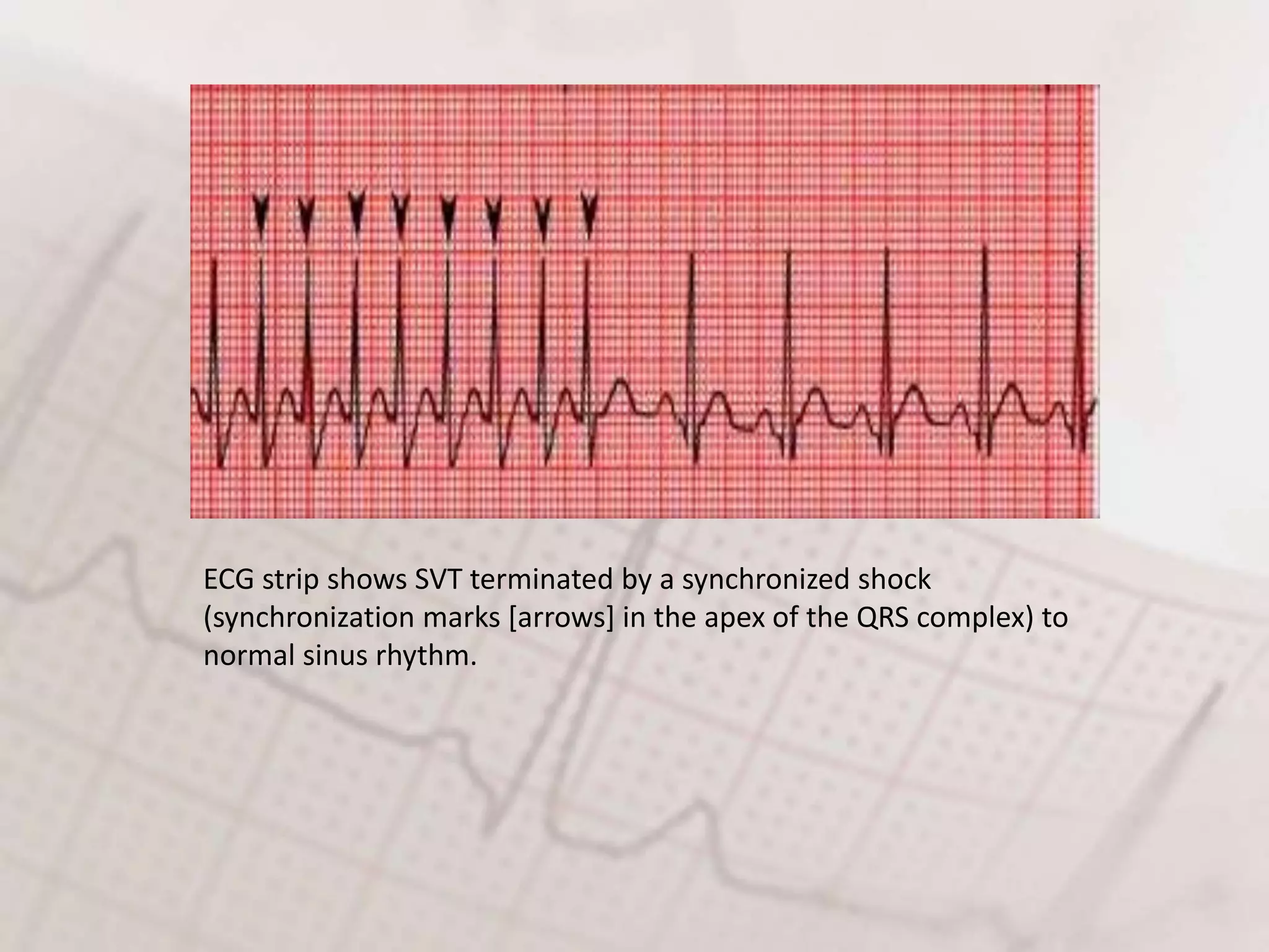 Defibrillation & Cardioversion | PPTX