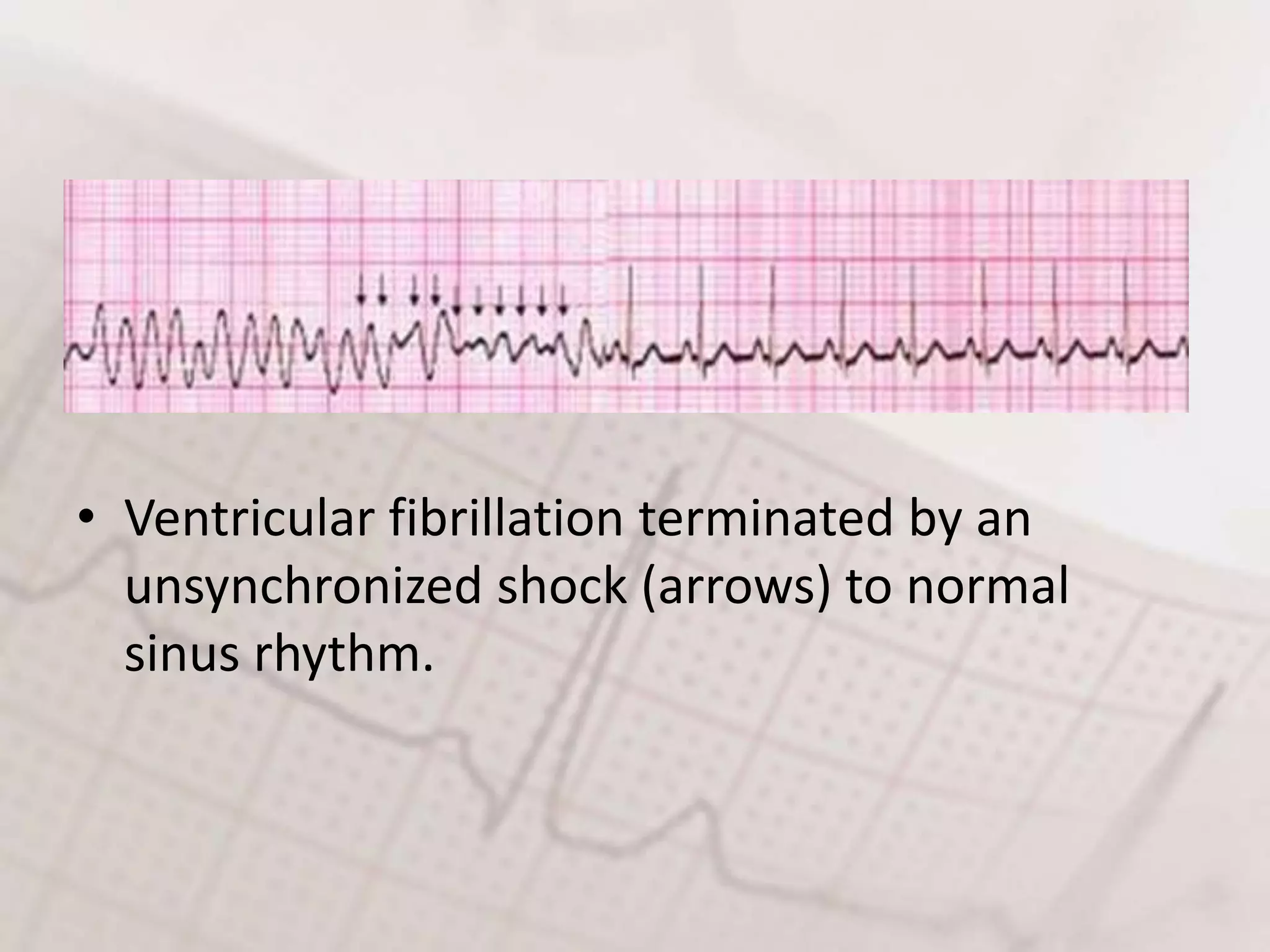 Defibrillation & Cardioversion | PPTX