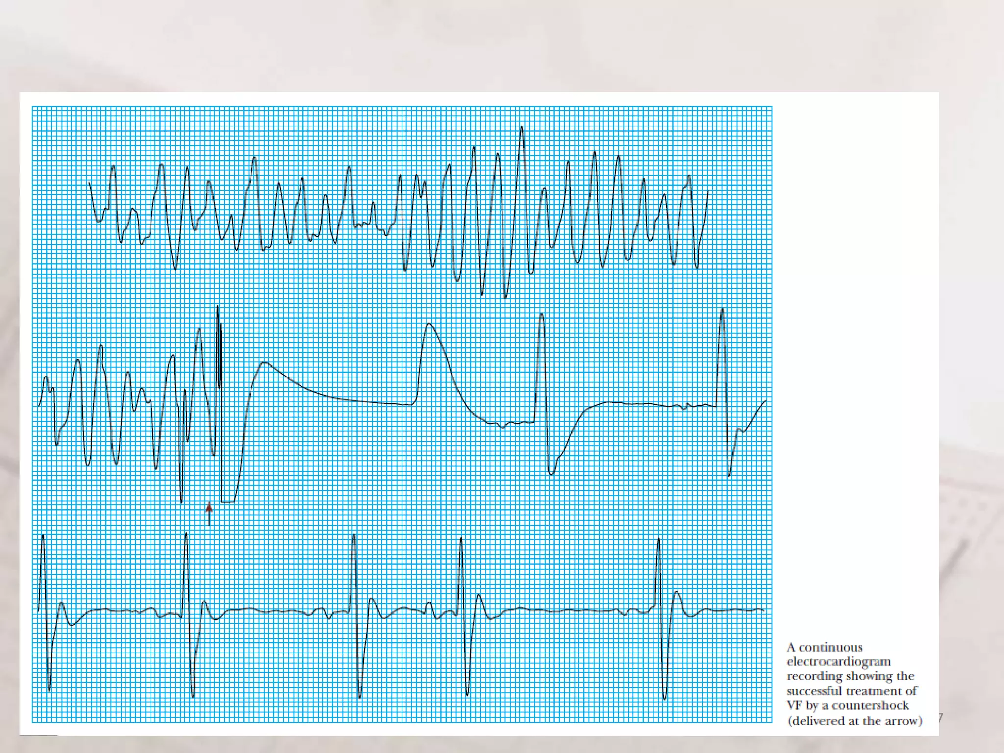 Defibrillation & Cardioversion | PPTX