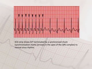 Defibrillation & Cardioversion | PPTX