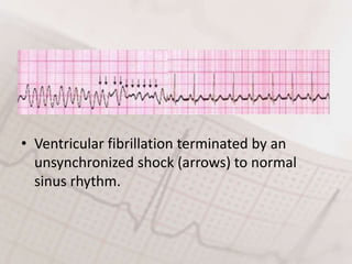 Defibrillation & Cardioversion | PPTX
