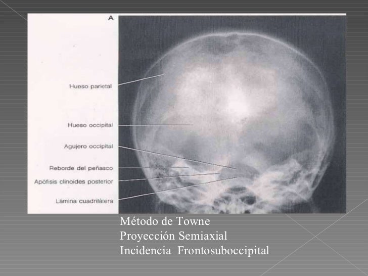 Puntos Craneometricos