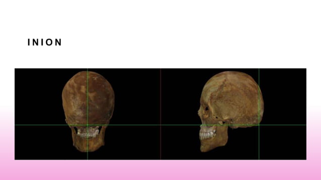 puntos craneometricos milagros.pptx de importancia | PPT
