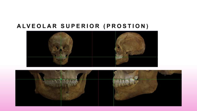 puntos craneometricos milagros.pptx de importancia | PPT