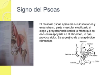 Puntos dolorosos apendicitis | PPTX