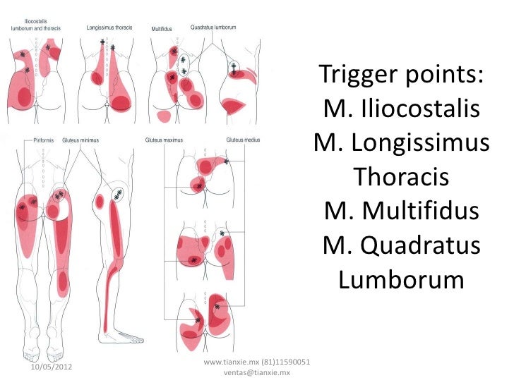 Trigger points: M. Iliocostalis M. Lo… | Trigger points, Shiatsu ...