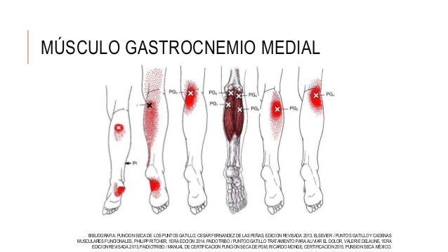 Puntos gatillo miofasciales (pgm)