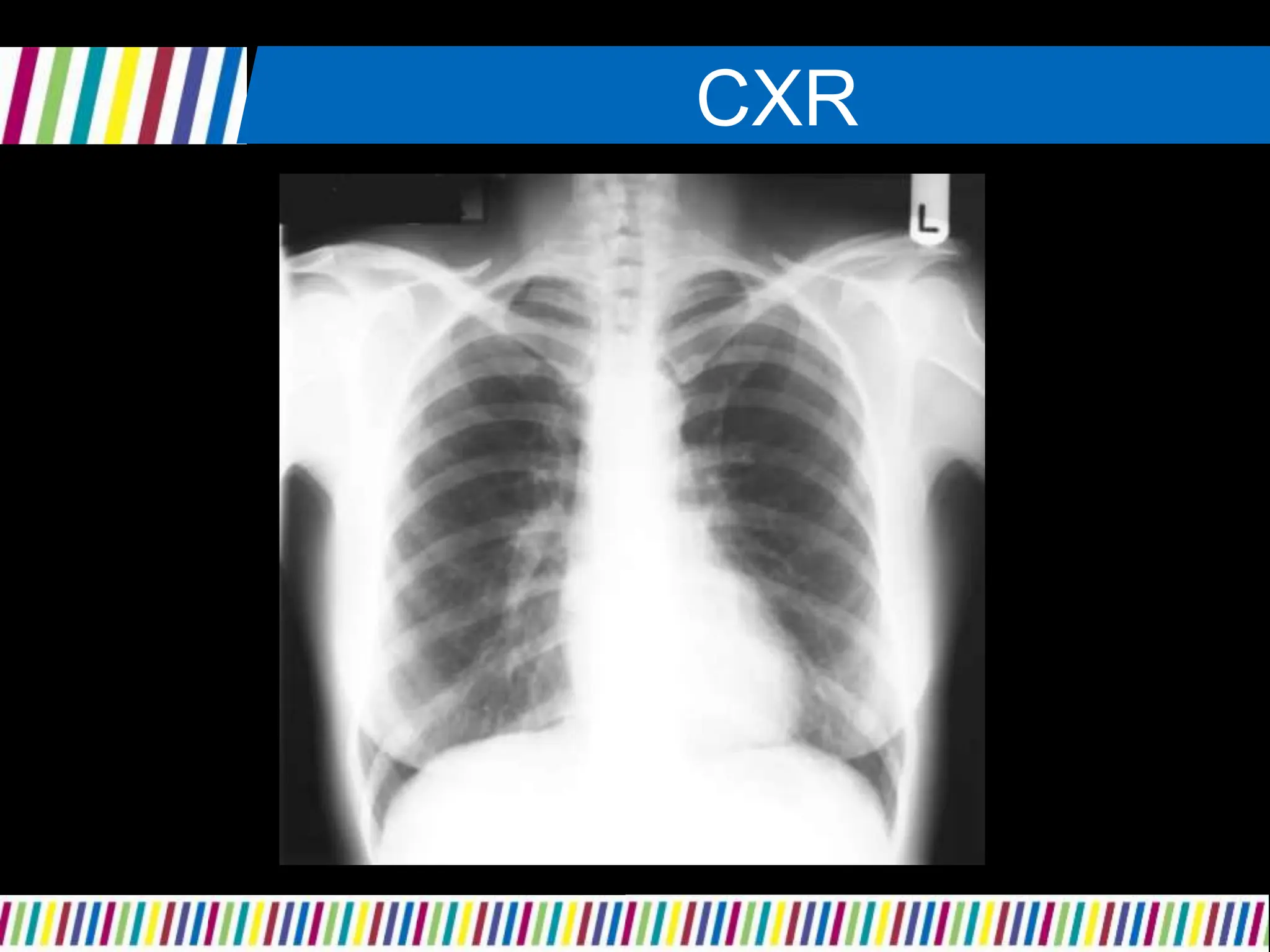 update pyrexia of unknown source 2024.pptx