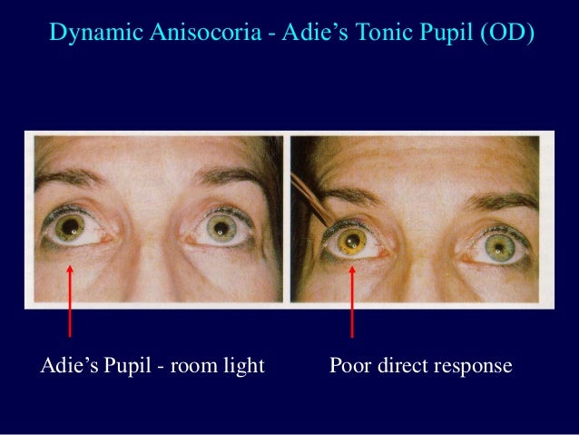 Abnormal Pupil Position