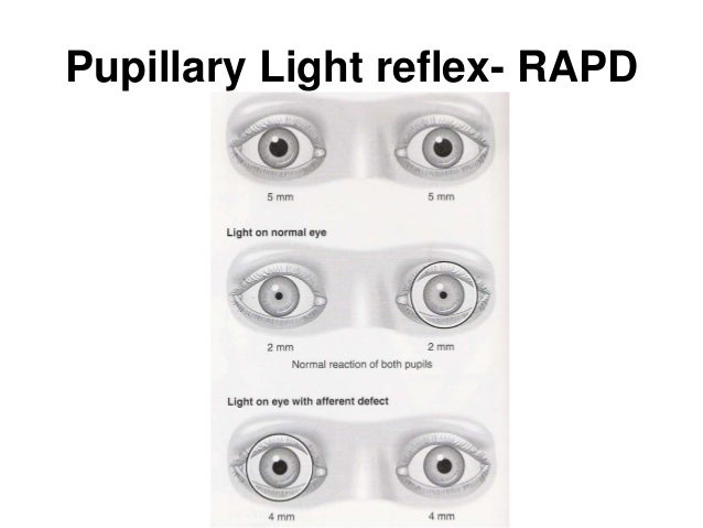 Pupillary Light Reflex Test Pupillary Response & Test Your Reaction