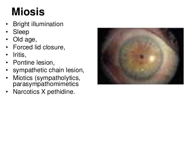 Miosis Vs Mydriasis