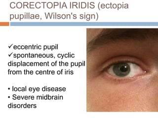 Pupil | PPT