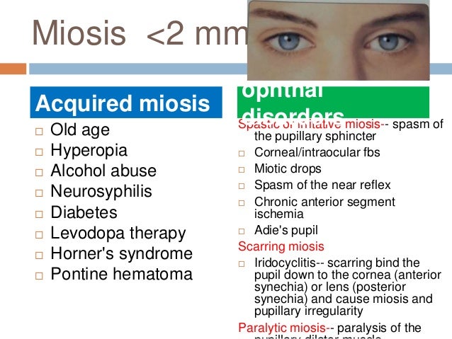Miosis Y Midriasis
