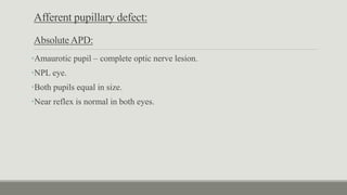 Pupil abnormalities | PPTX