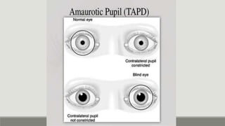 Pupil abnormalities | PPTX