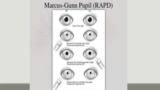Pupil abnormalities | PPTX