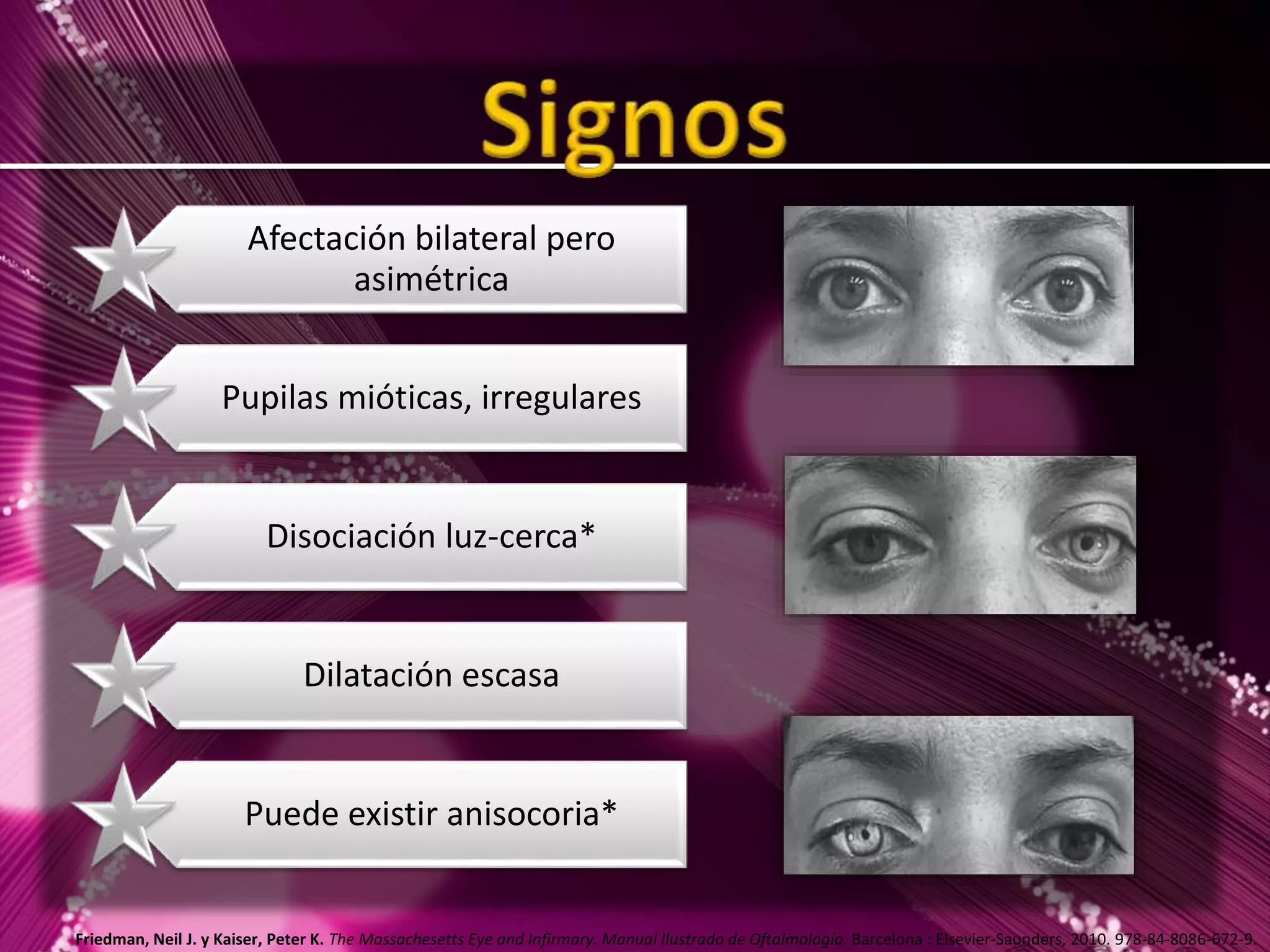 Pupila de Argyll Robertson | PPT