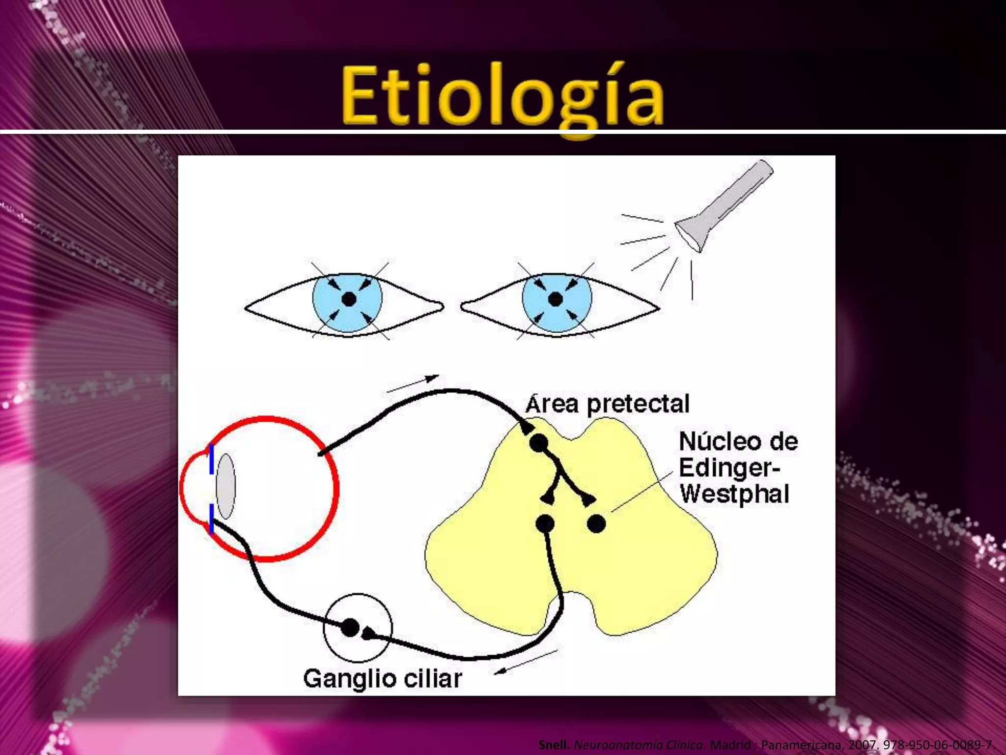 Pupila de Argyll Robertson | PPT