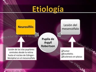 Pupila de Argyll Robertson | PPSX
