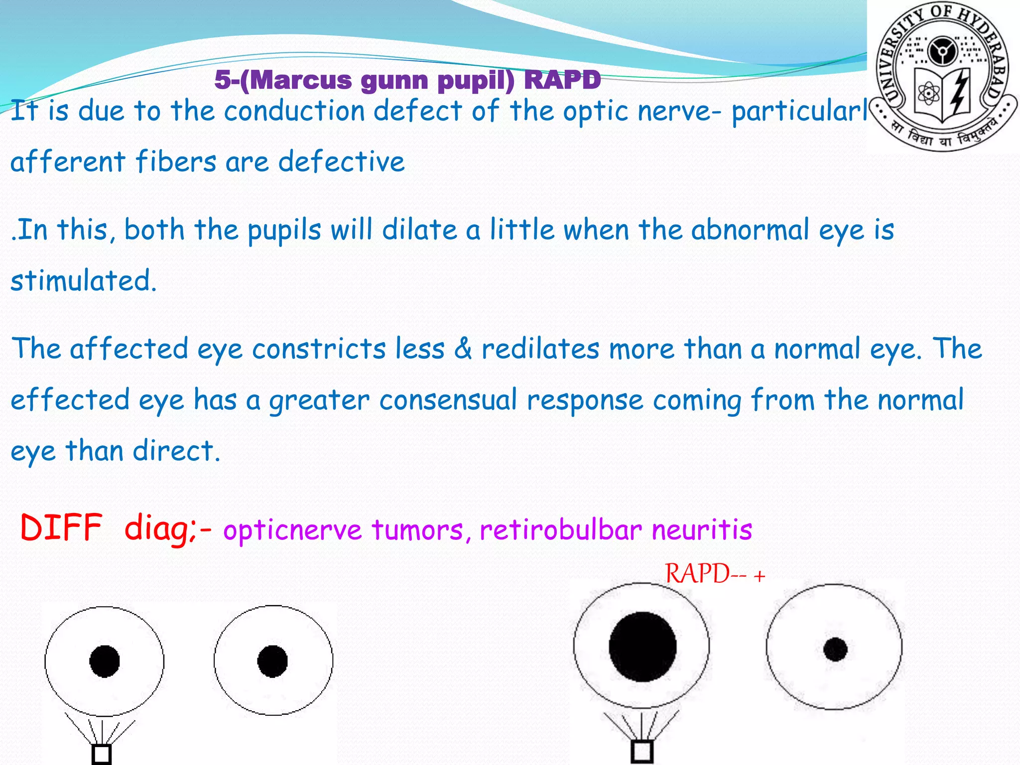 Pupil anomalies and disorders shiva ppt | PPTX | Eye and Vision ...