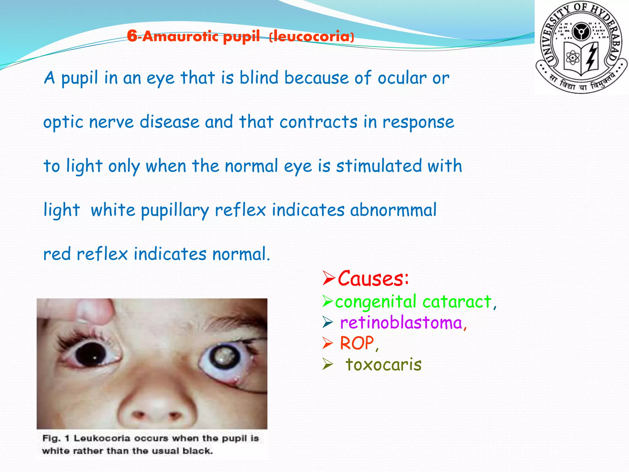 Pupil anomalies and disorders shiva ppt | PPTX | Eye and Vision ...