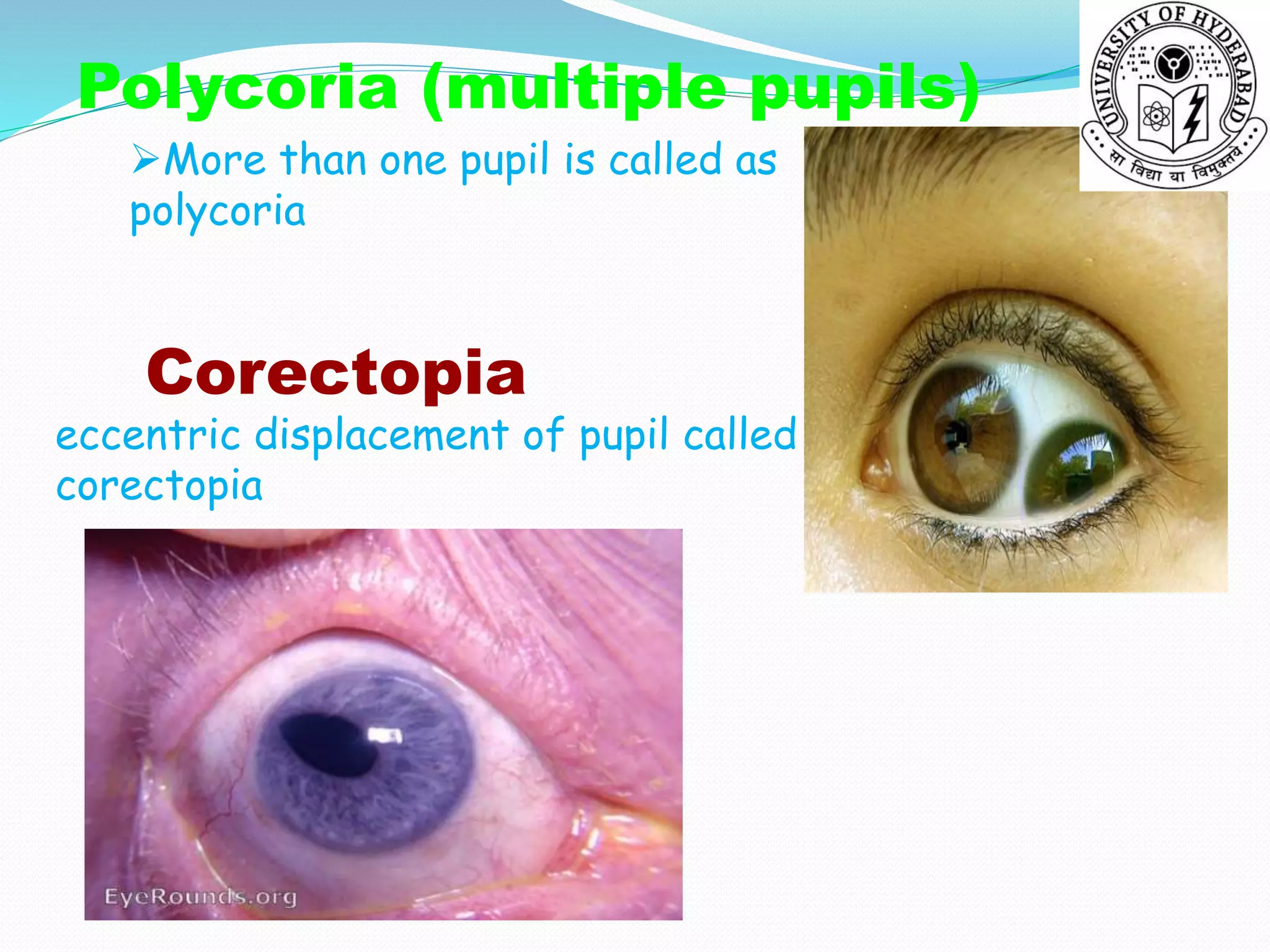 Pupil anomalies and disorders shiva ppt | PPTX | Eye and Vision ...