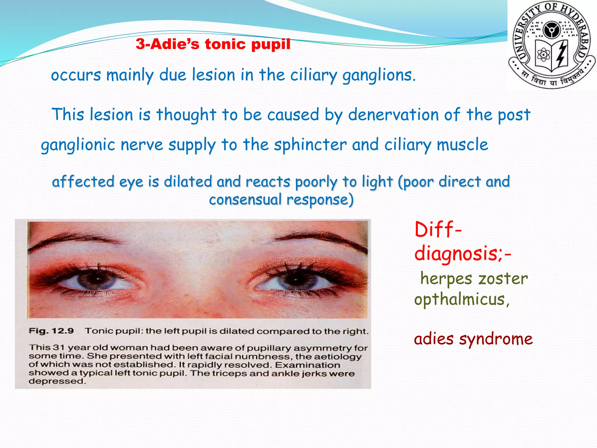 Pupil anomalies and disorders shiva ppt | PPTX | Eye and Vision ...