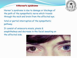 Pupil anomalies and disorders shiva ppt | PPTX | Eye and Vision ...