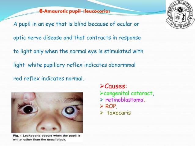 Pupil anomalies and disorders shiva ppt | PPTX | Eye and Vision ...