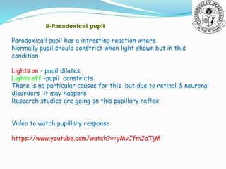 Pupil anomalies and disorders shiva ppt | PPTX | Eye and Vision ...