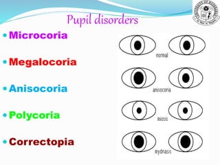 Pupil anomalies and disorders shiva ppt | PPTX | Eye and Vision ...