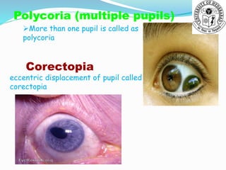 Pupil anomalies and disorders shiva ppt | PPTX | Eye and Vision ...