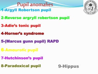 Pupil anomalies and disorders shiva ppt | PPTX | Eye and Vision ...