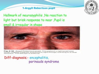 Pupil anomalies and disorders shiva ppt | PPTX | Eye and Vision ...