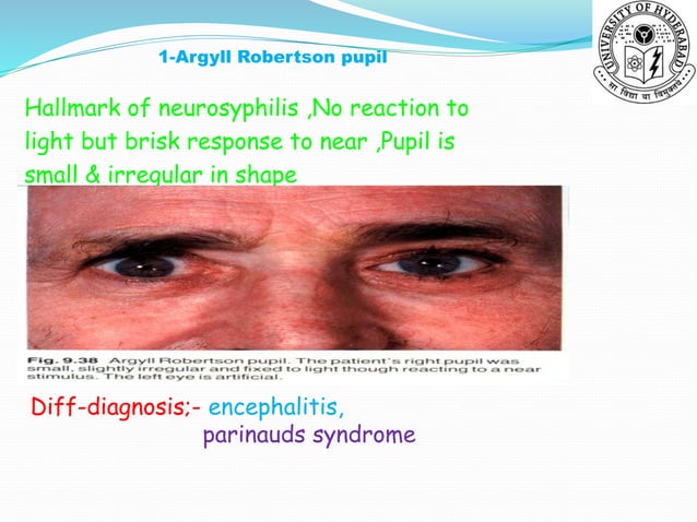 Pupil anomalies and disorders shiva ppt | PPTX | Eye and Vision ...