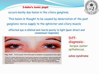 Pupil anomalies and disorders shiva ppt | PPTX