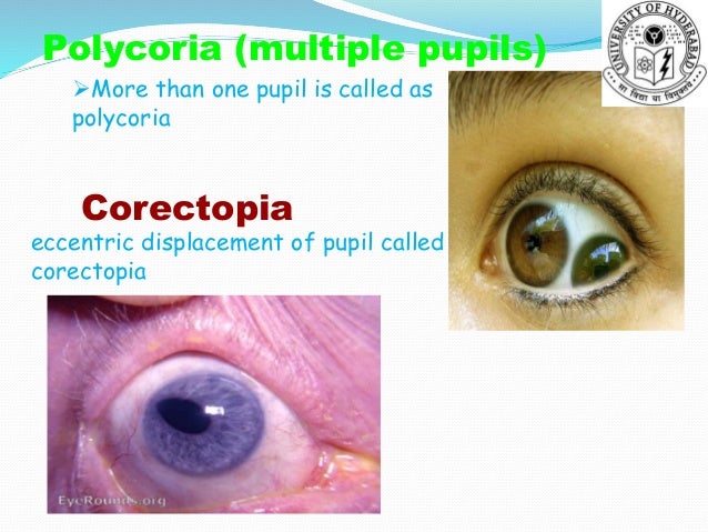 Pupil anomalies and disorders shiva ppt