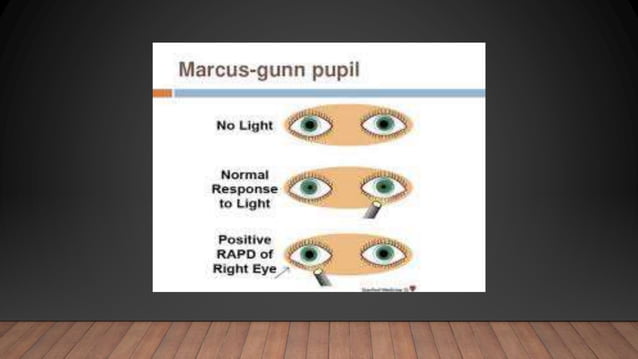 PUPILARY REFLEX PATHWAYS.pptx | Eye and Vision Conditions | Diseases ...