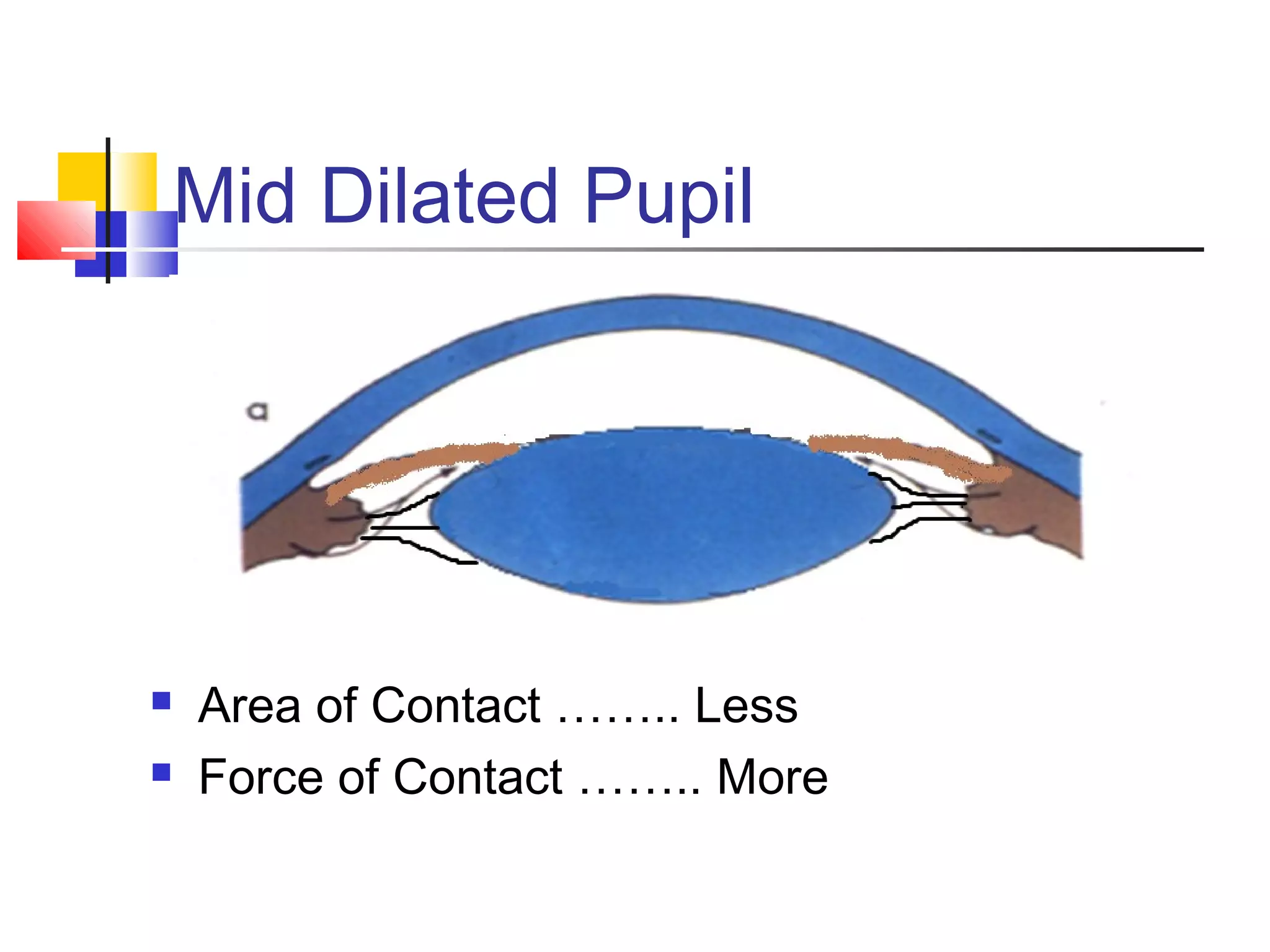 Pupil block glaucoma | PPT