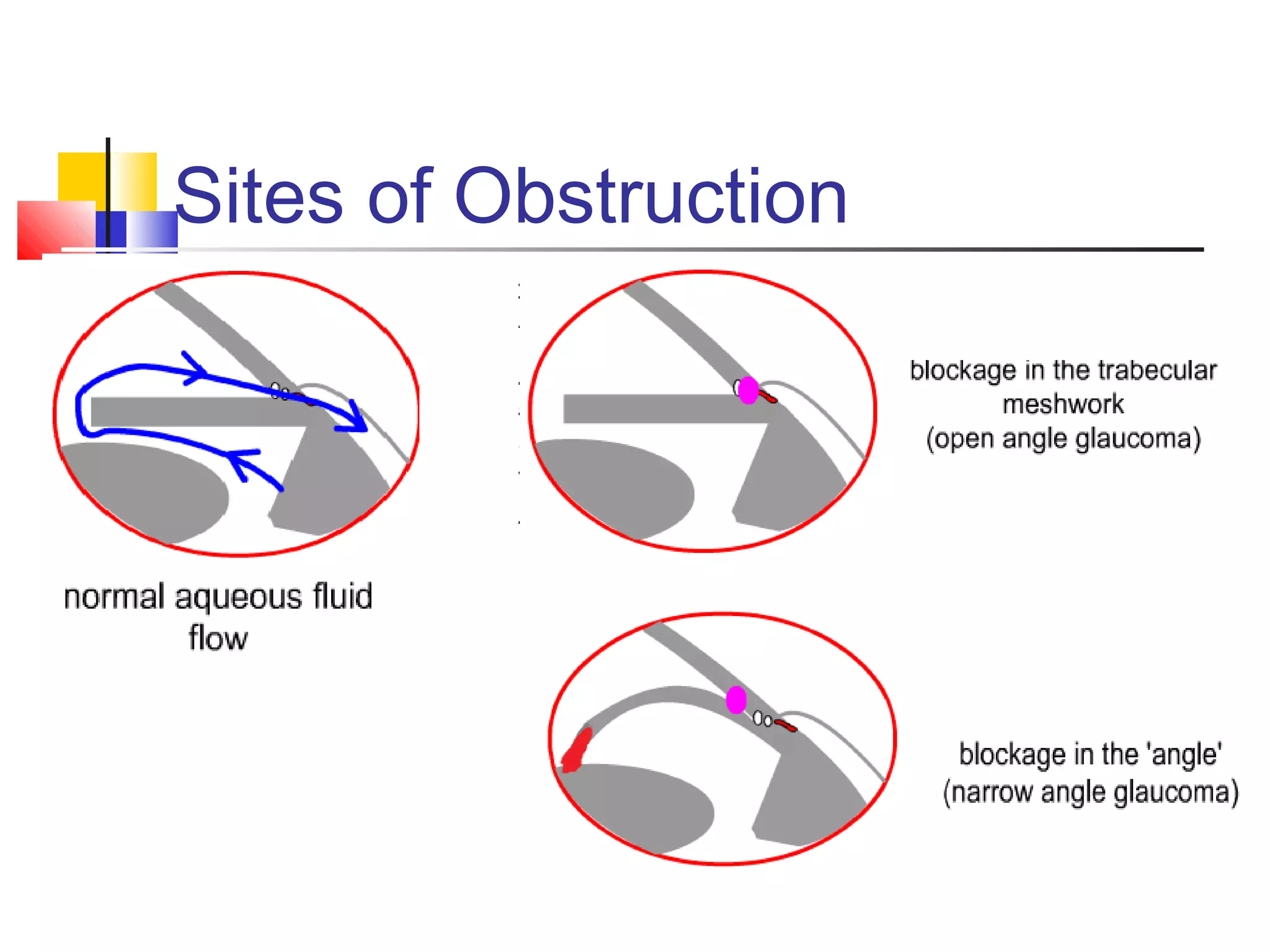 Pupil block glaucoma | PPT