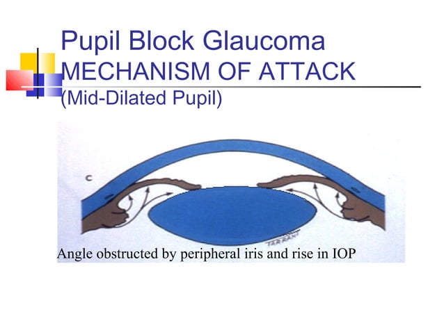 Pupil block glaucoma | PPT | Eye and Vision Conditions | Diseases and ...